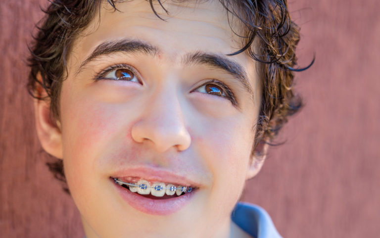 A Guide to Getting Braces Just on Your Bottom or Top Teeth | Orthodontist